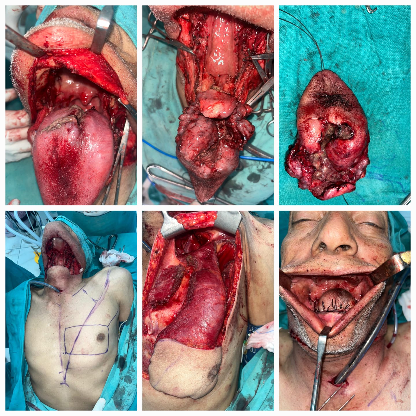 Total Glossectomy with Supraglottic Laryngectomy - Dr. Bhushan Kathuria